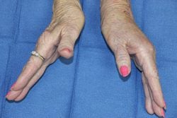 Wrist Arthritis Solutions