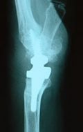 Wrist Arthritis Solutions
